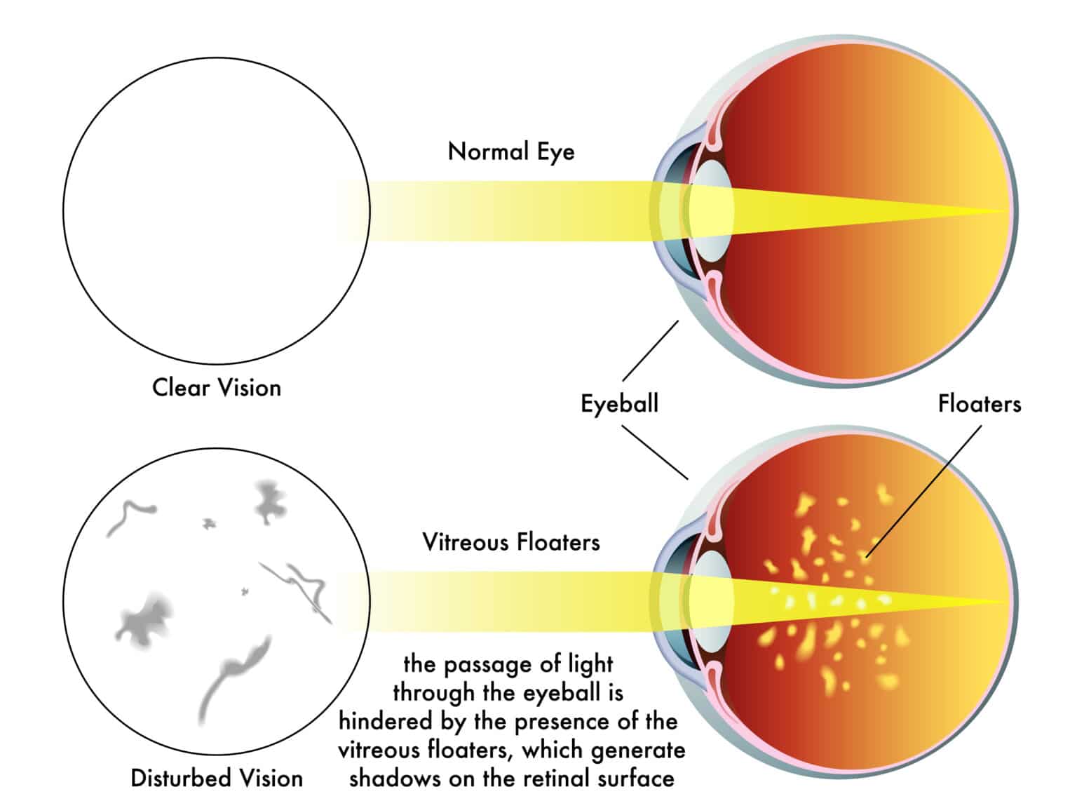 Treatment For Flashes And Floaters Fort Myers Eye Centers Of Florida